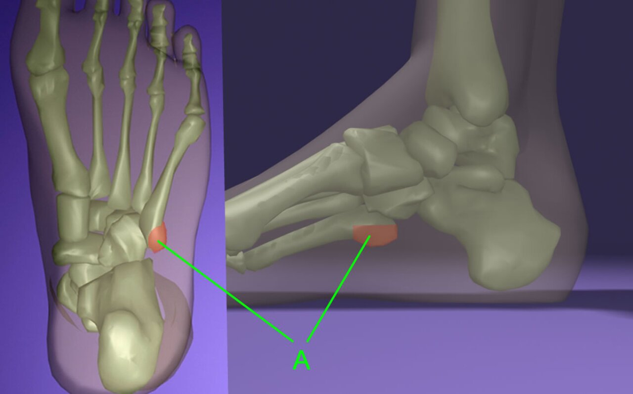 Fájdalmas Csontdudor, Bőrkeményedés A Láb Külső Oldalán Alul, Középen