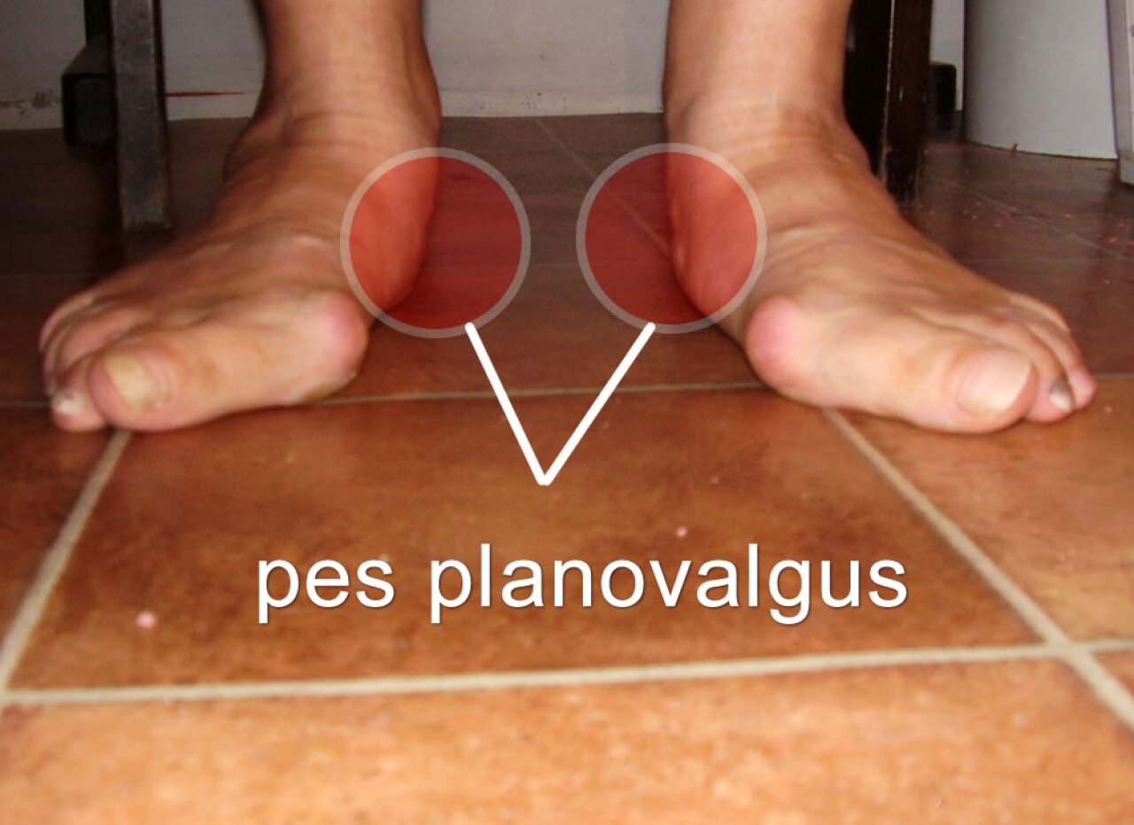 Ellapult Láb, Bokák Egymás Felé Billennek, Körben Fájdalmas Bokaizület ...